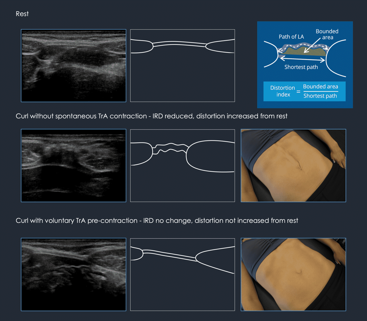 Diastasis Rectus Abdominis | Abdominal Separation - Nell Mead