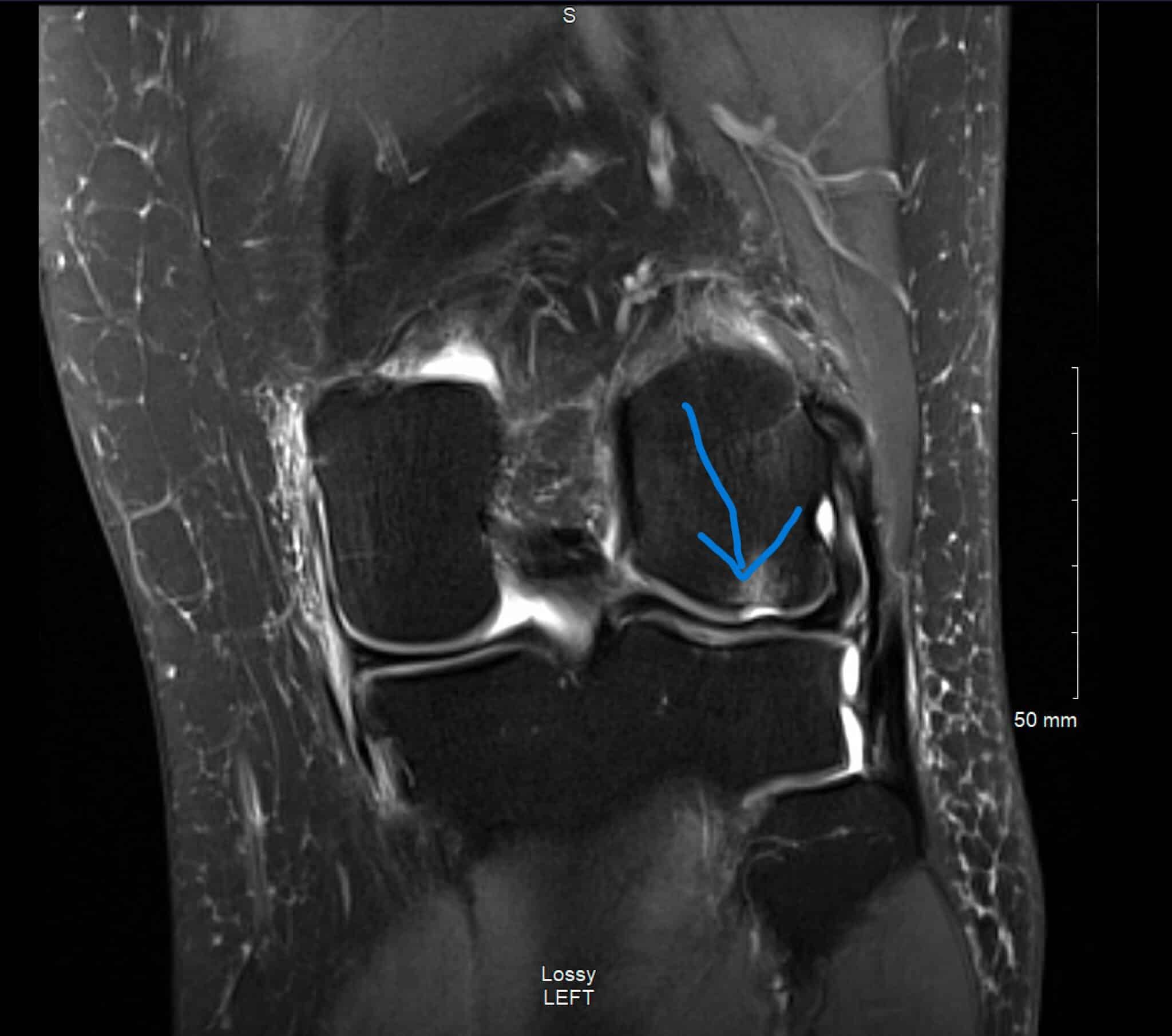 Femoral chondral defect 2: diagnosis and plan - Nell Mead