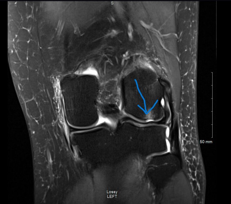 Femoral chondral defect 2: diagnosis and plan - Nell Mead